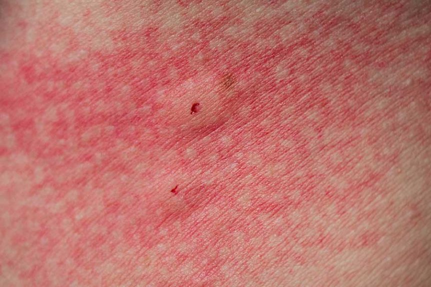 Brown Recluse Spider Bite Treatment - Earther Academy